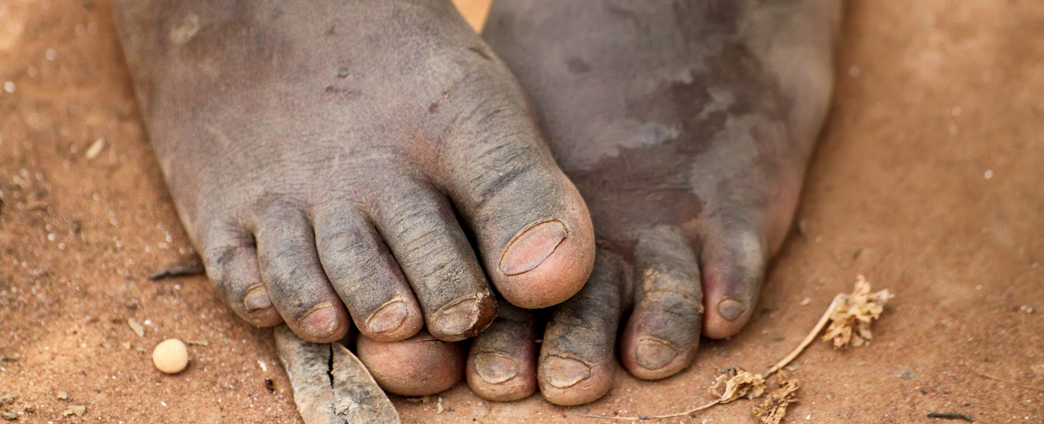 Guinea-Worm Disease (Dracunculiasis) | WHO | Regional Office for Africa